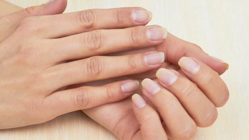 Tırnakta oluşan beyaz lekelere dikkat! O hastalığın habercisi olabilir ...